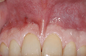 Laser Frenectomy | Tongue Tie Treatment | Dr. Bruce B. Wiland