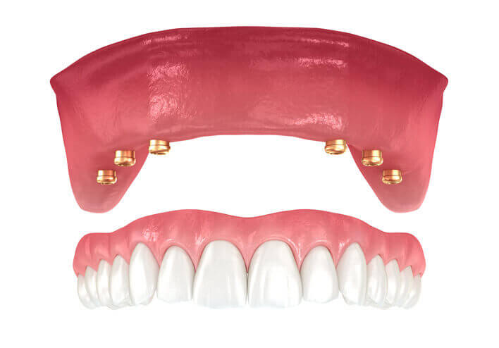 Dentures That Snap Onto Dental Implants or Implant Retained Denture
